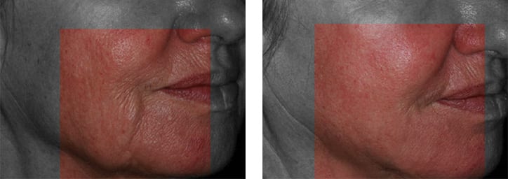 A CFDA Exclusive: The Infini! - Central Florida Dermatology Associates